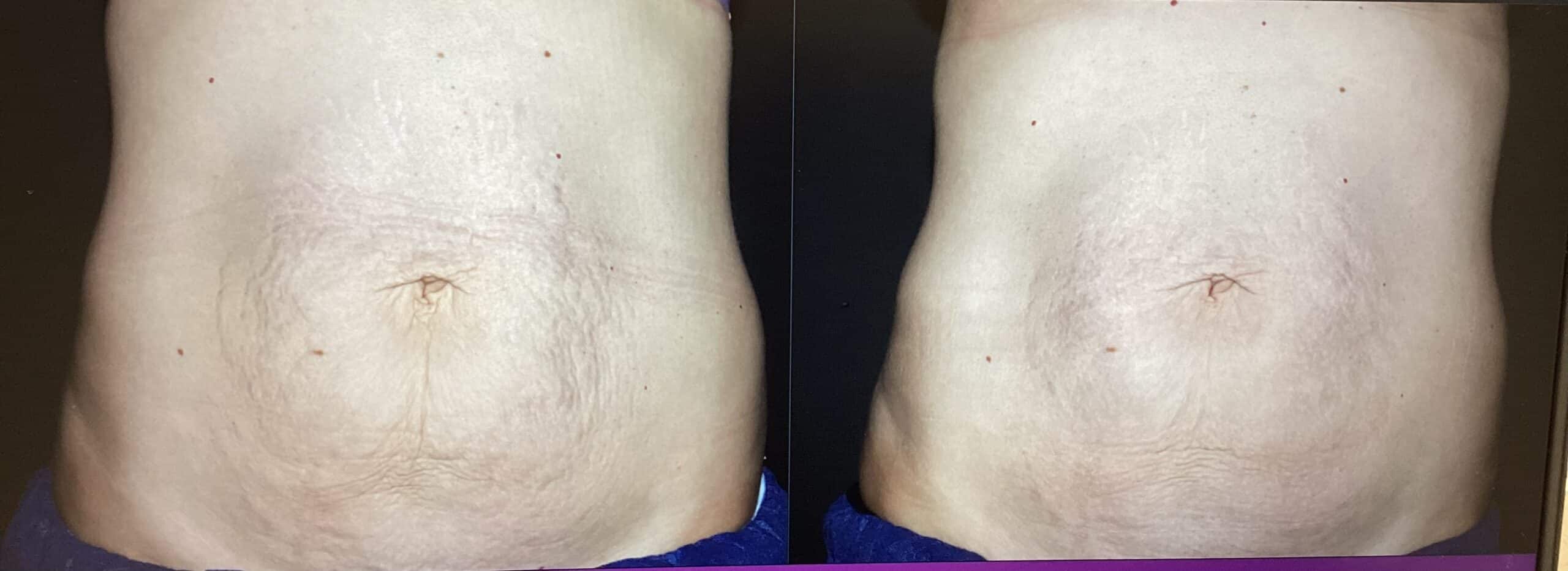 Sculptology | CoolSculpting® Specialized Center